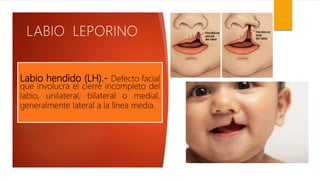 Labio y paladar hendido GENETICA CLINICA | PPTX