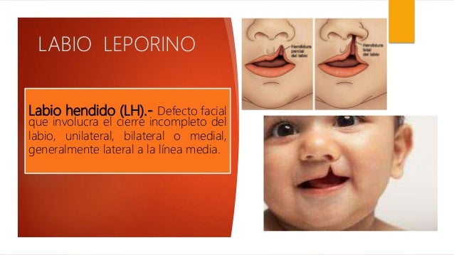 Labio y paladar hendido GENETICA CLINICA