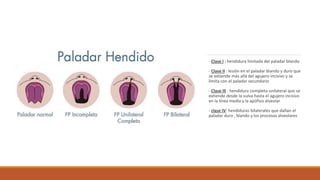 Labio y paladar hendido | PPTX