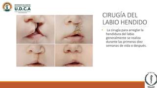 Labio y paladar hendido | PPTX