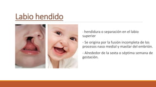 Labio y paladar hendido | PPTX