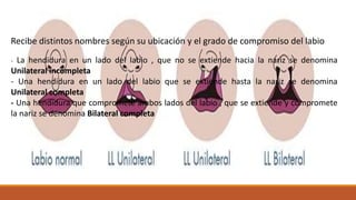 Labio y paladar hendido | PPTX