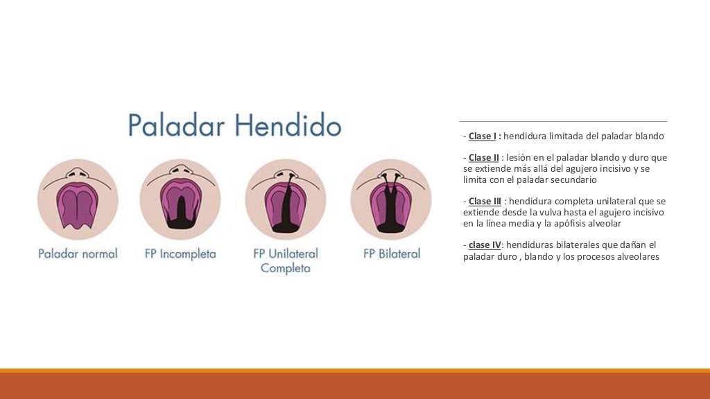 Labio y paladar hendido