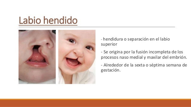 Labio y paladar hendido