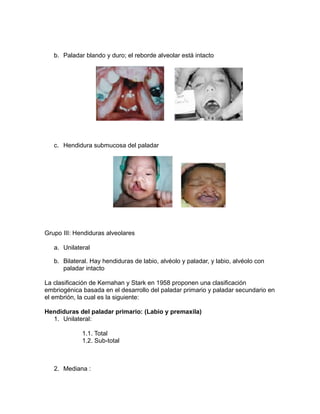Labio y paladar hendido | DOC