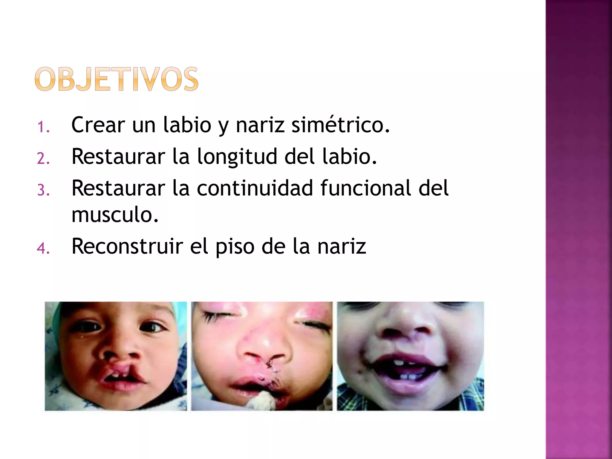 LABIO Y PALADAR HENDIDO | PPTX