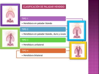 LABIO Y PALADAR HENDIDO | PPTX