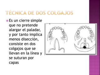 LABIO Y PALADAR HENDIDO | PPTX