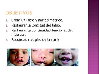 LABIO Y PALADAR HENDIDO | PPTX