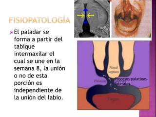 LABIO Y PALADAR HENDIDO | PPTX