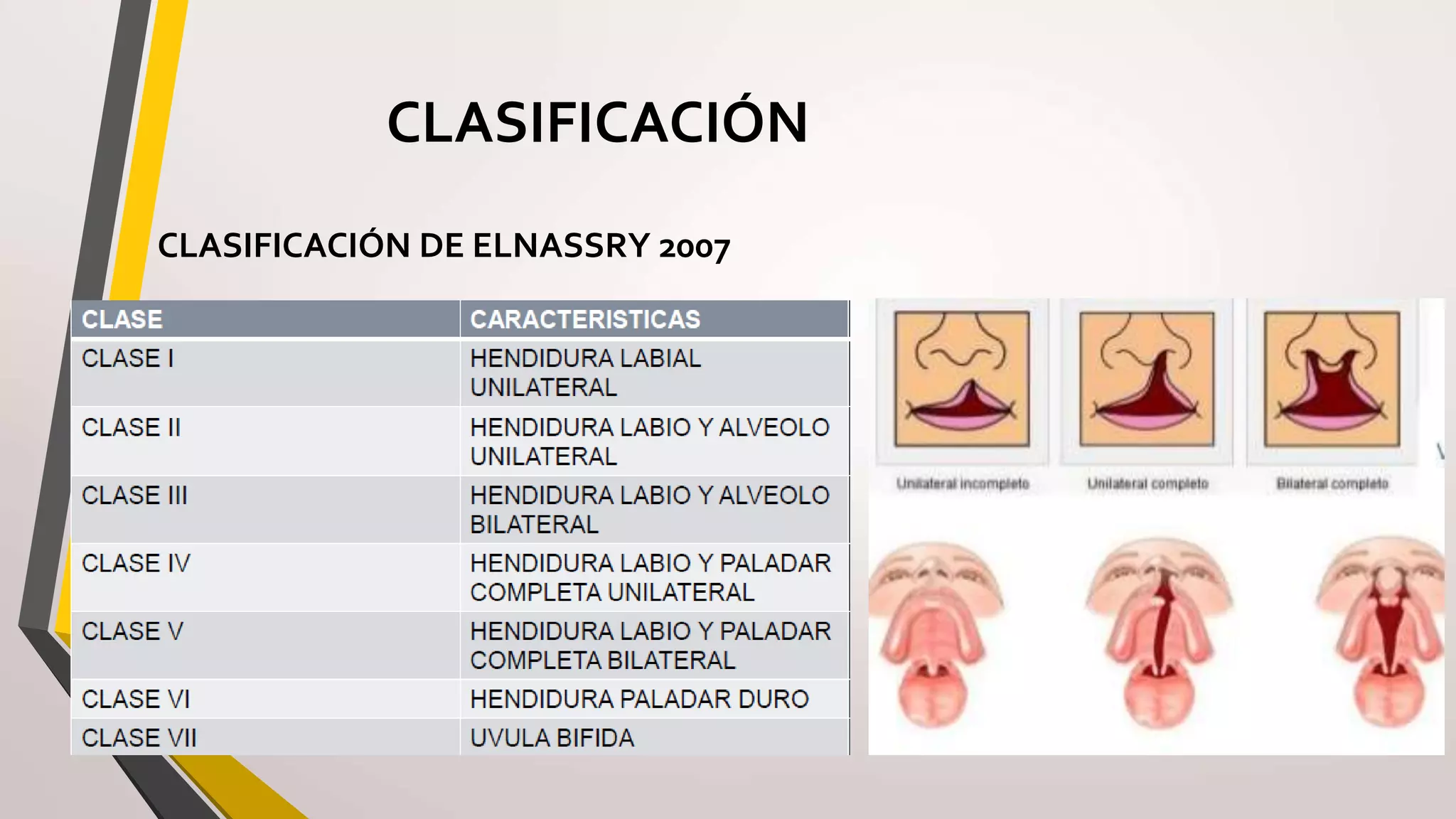 Labio y paladar hendido | PPTX