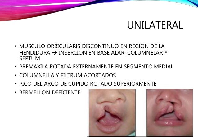 Labio y paladar hendido