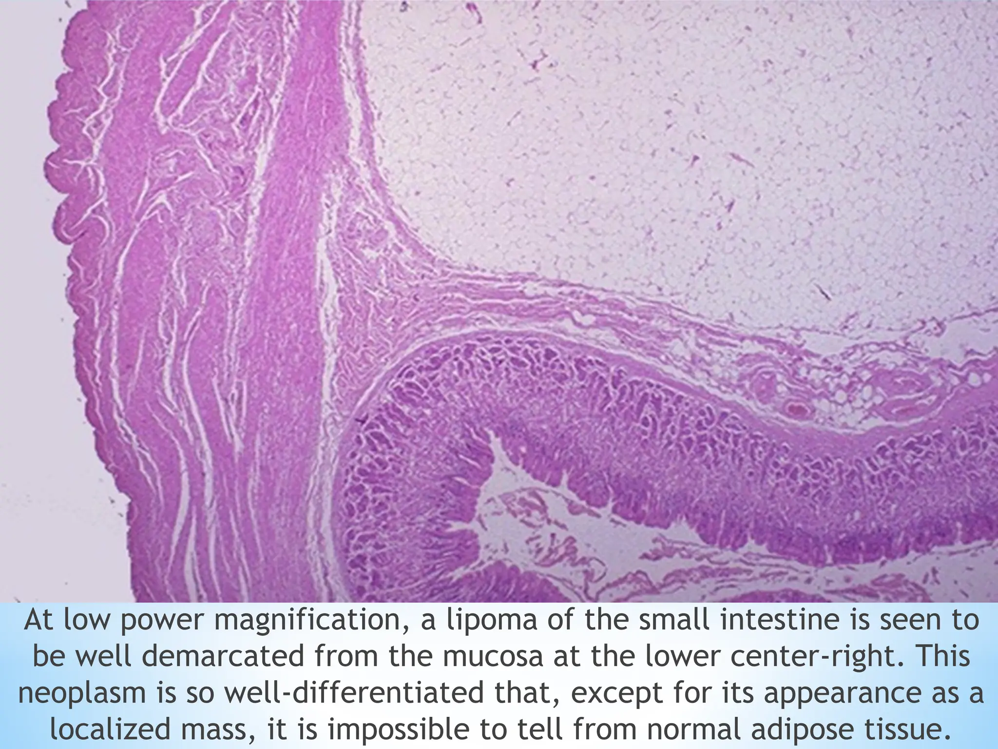 Lab No.1 Neoplasia.pdf’……………………………………….. | PDF