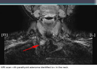 laboratory and radiological findings in hyperparathyroidism | PPTX