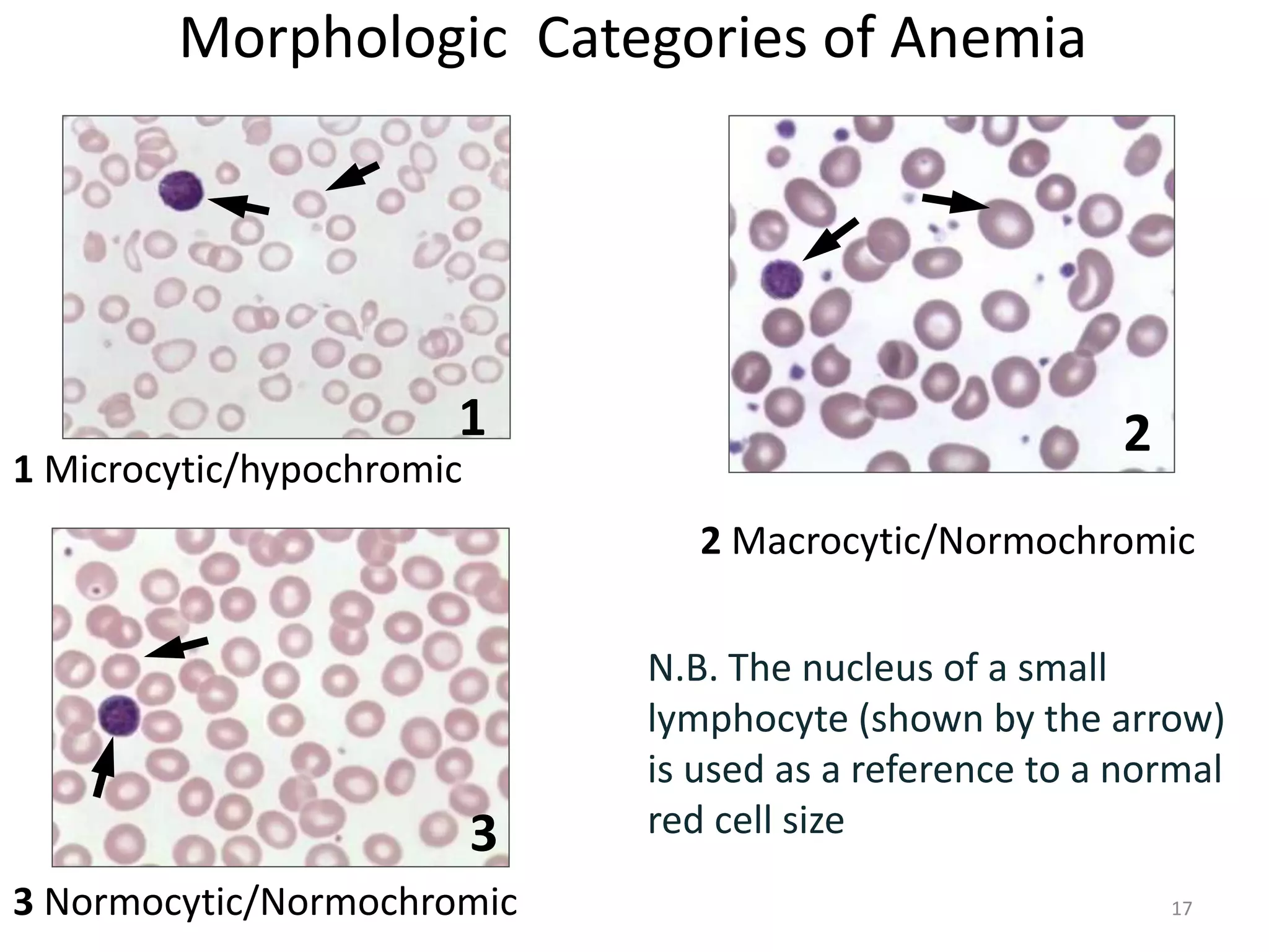 Laboratory diagnosis of anemia | PPTX