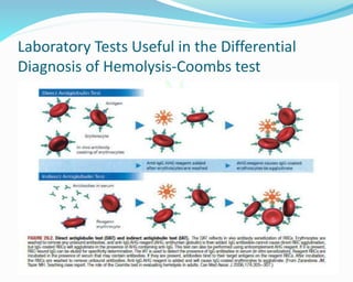 laboratory diagnosis of hemolytic anemia-190509145931.pptx