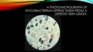 Laboratory diagnosis of leprosy | PPTX