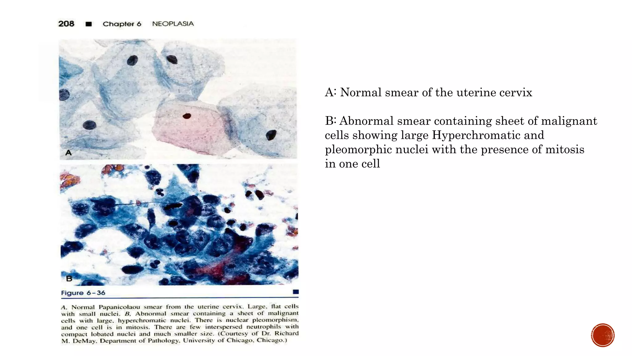 Laboratory diagnosis of neoplasm | PPTX
