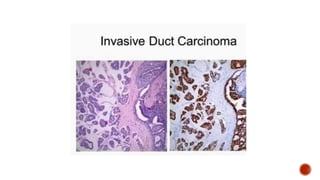 Laboratory diagnosis of neoplasm | PPTX | Cancer | Diseases and Conditions