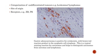 Laboratory diagnosis of neoplasm | PPTX