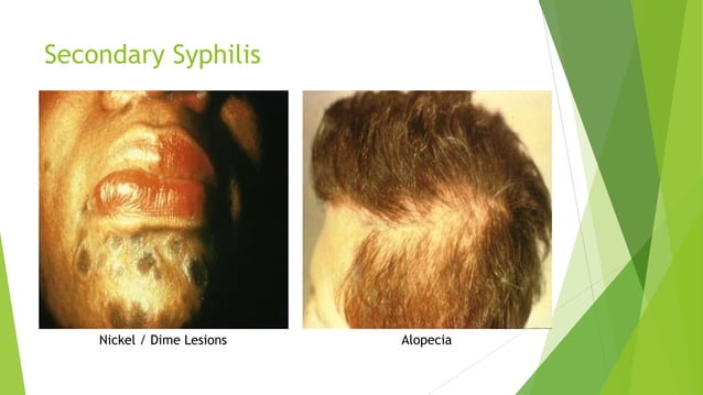 Laboratory diagnosis of syphilis | PPT