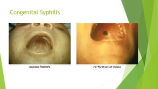 Laboratory diagnosis of syphilis | PPT