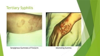 Laboratory Diagnosis of Syphilis 2.0.pptx