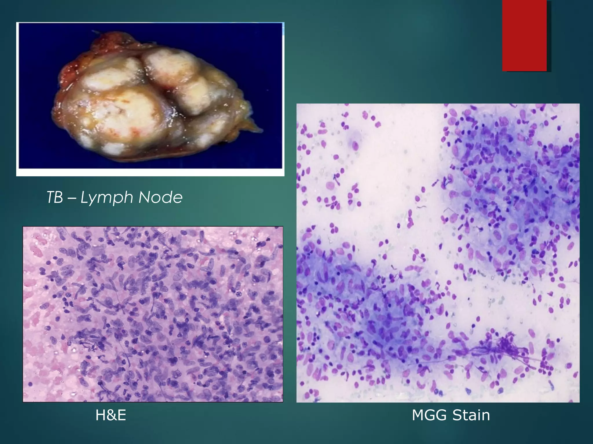 Laboratory diagnosis of Tuberculosis gs | PPT