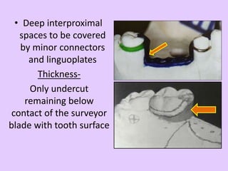 Laboratory procedure in rpd fabrication | PPTX