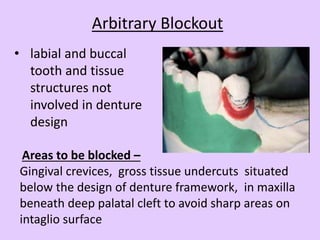 Laboratory procedure in rpd fabrication | PPTX