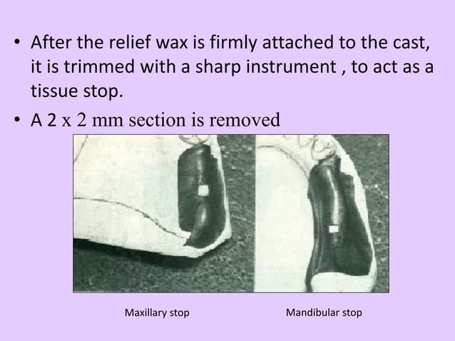 Laboratory procedure in rpd fabrication | PPTX | Dental Health ...