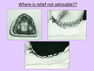 Laboratory procedure in rpd fabrication | PPTX