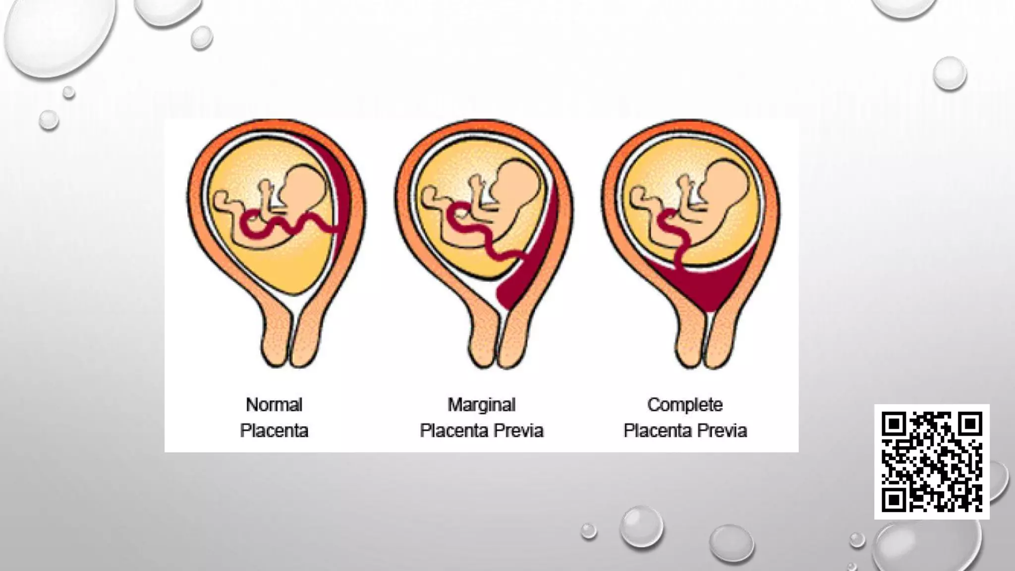 Labour complications | PPTX