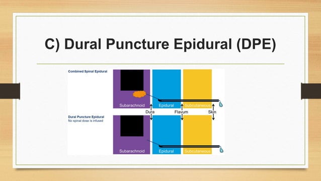 Labour Epidural (breakthrough pain).pptx