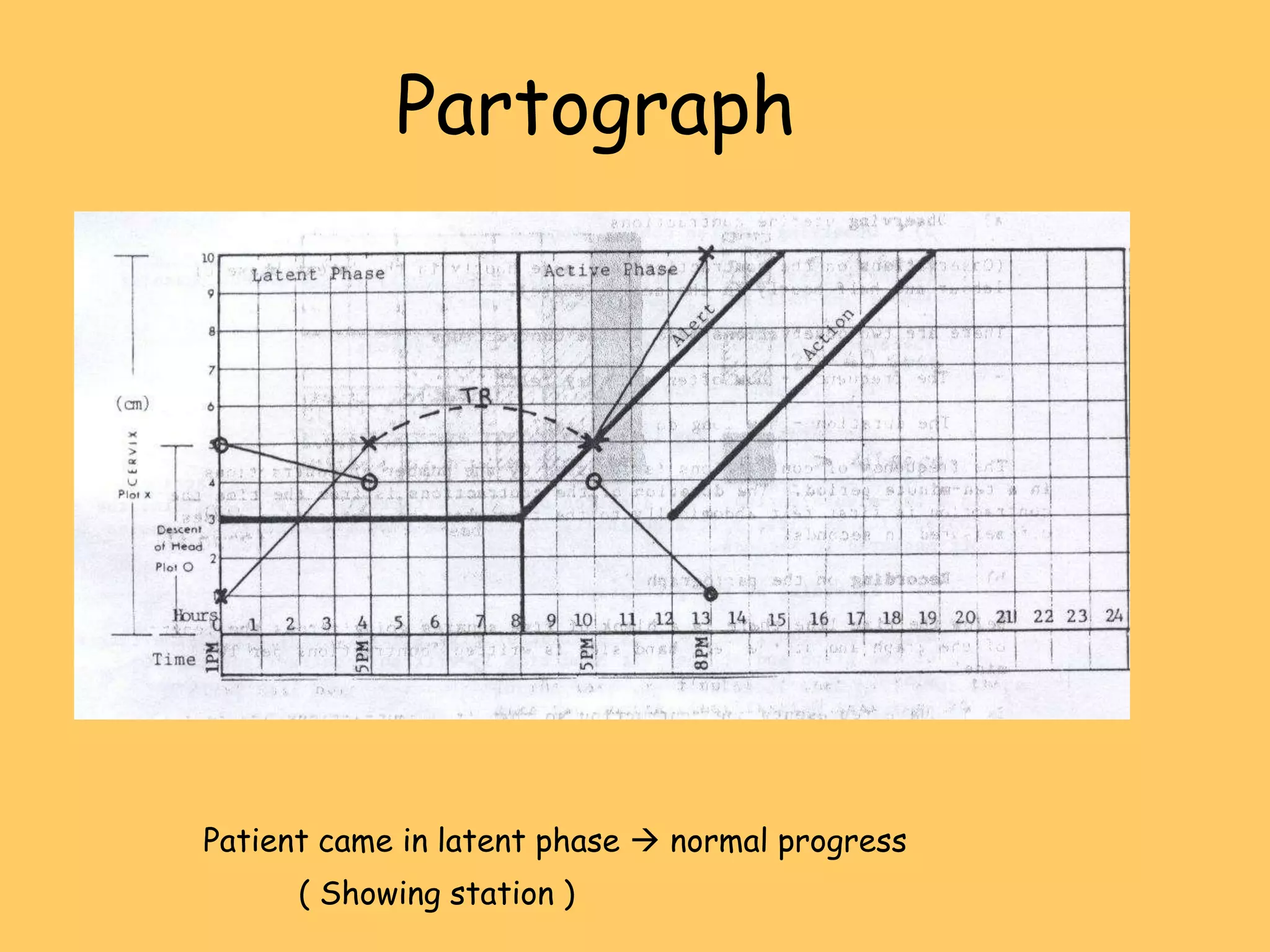 Dysfunctional Labour & Partograph | PPTX