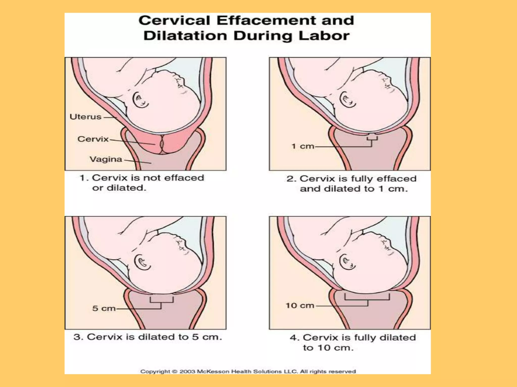 Dysfunctional Labour & Partograph | PPTX