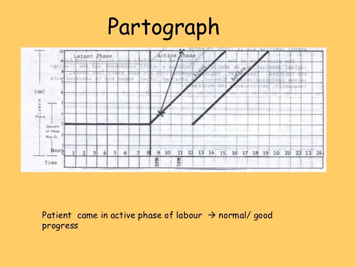 Dysfunctional Labour & Partograph