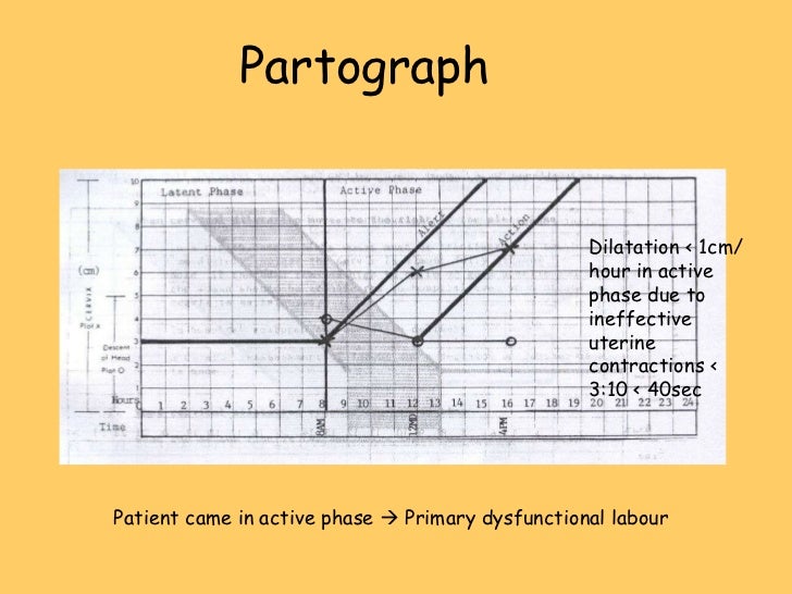Dysfunctional Labour & Partograph