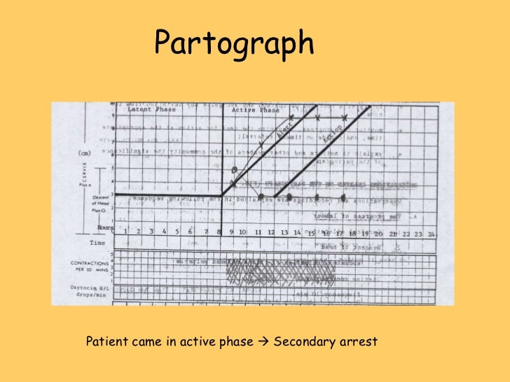 Dysfunctional Labour And Partograph