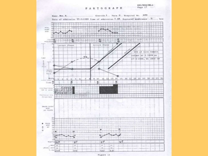 Dysfunctional Labour & Partograph