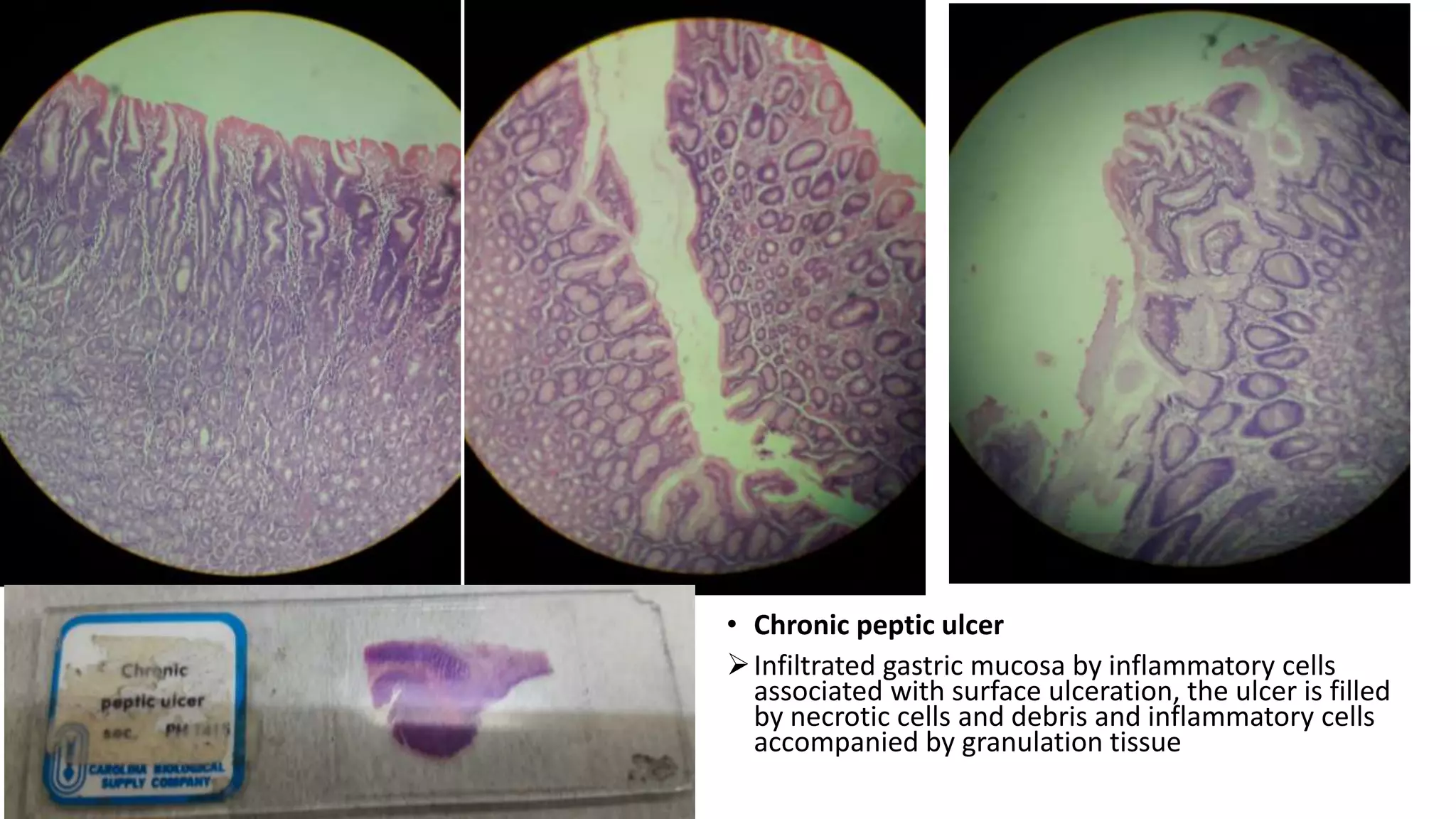 pathology slides of GIT system | PPTX | Digestive Disorders | Diseases ...