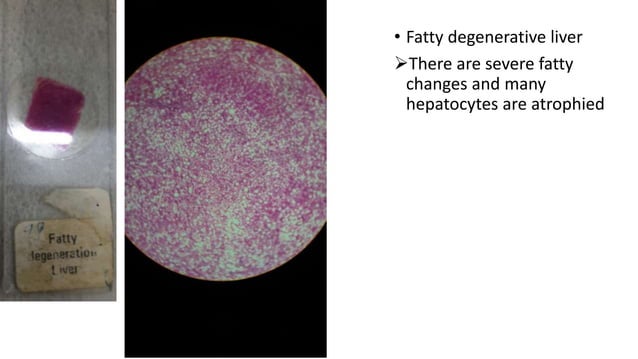 pathology slides of GIT system | PPTX | Digestive Disorders | Diseases ...