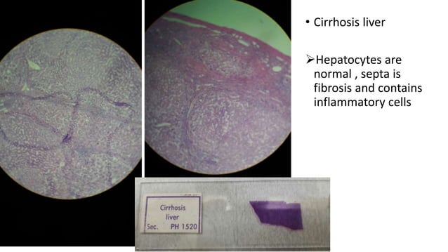 pathology slides of GIT system | PPTX | Digestive Disorders | Diseases ...