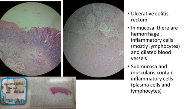 pathology slides of GIT system | PPTX | Digestive Disorders | Diseases ...