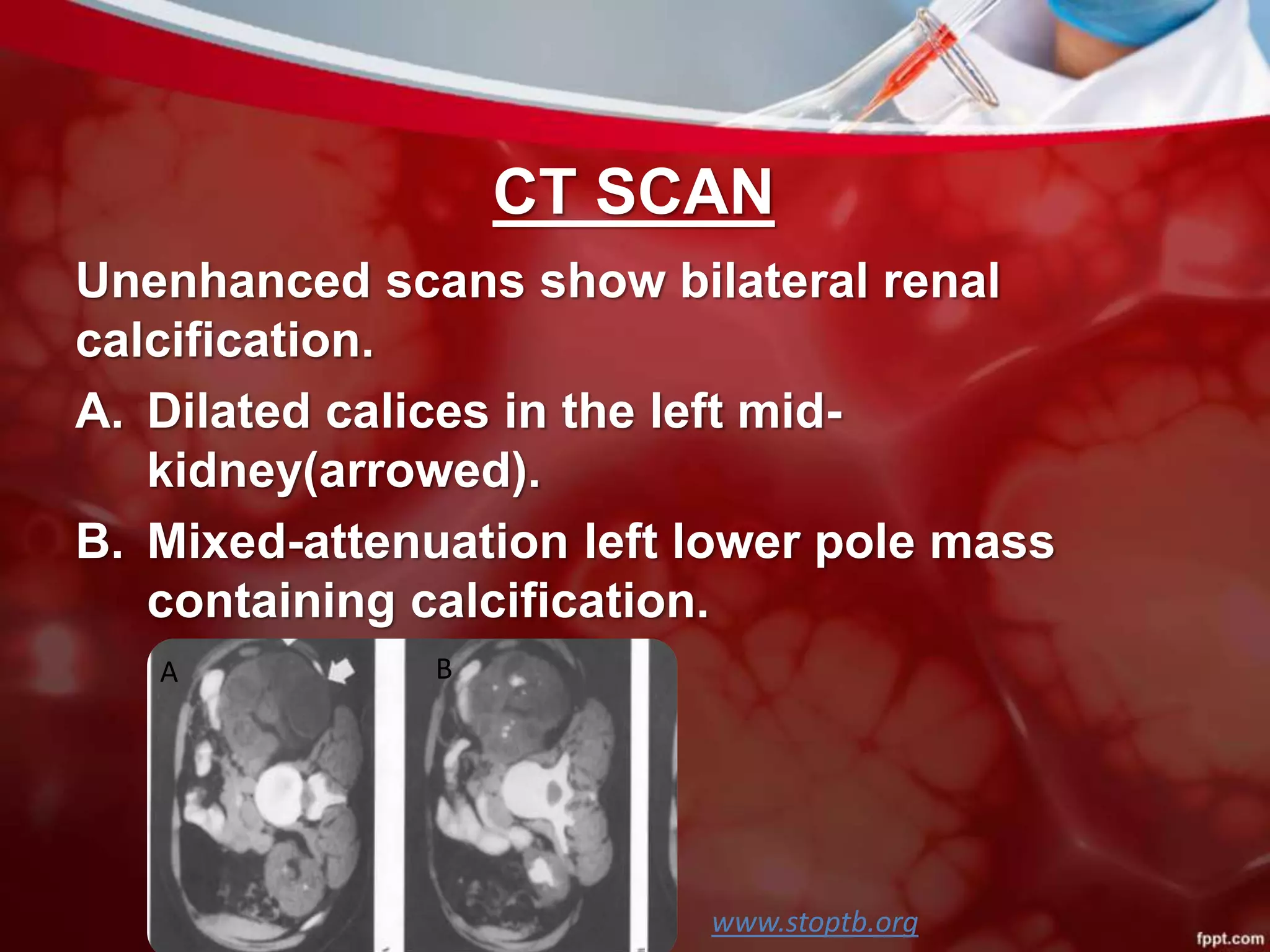 NON-PULMONARY TUBERCULOSIS(RENAL TB) | PPTX