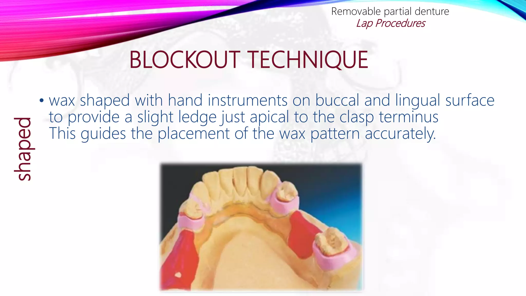 Lab steps of partial denture framework construction | PPTX