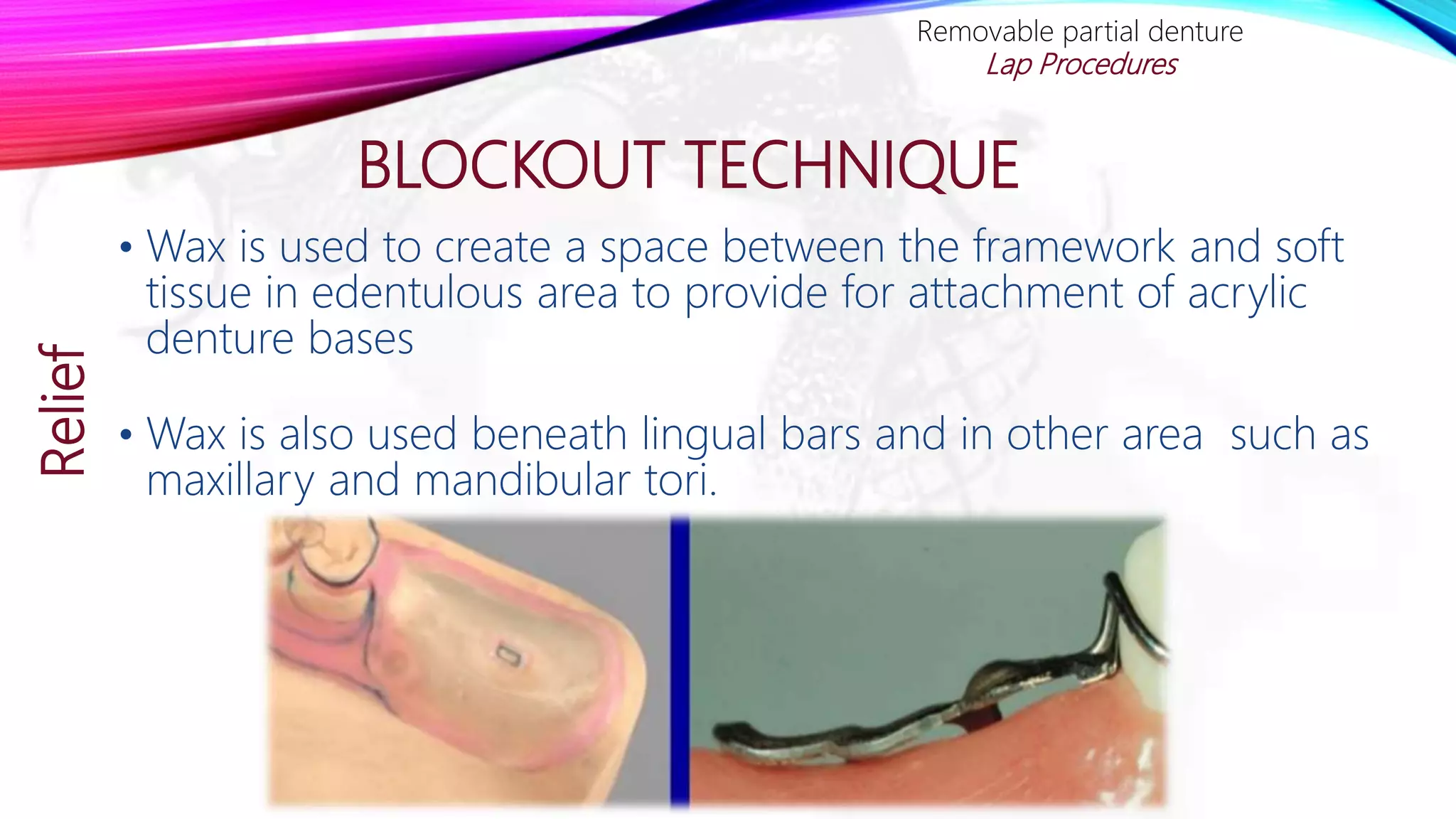 Lab steps of partial denture framework construction | PPTX