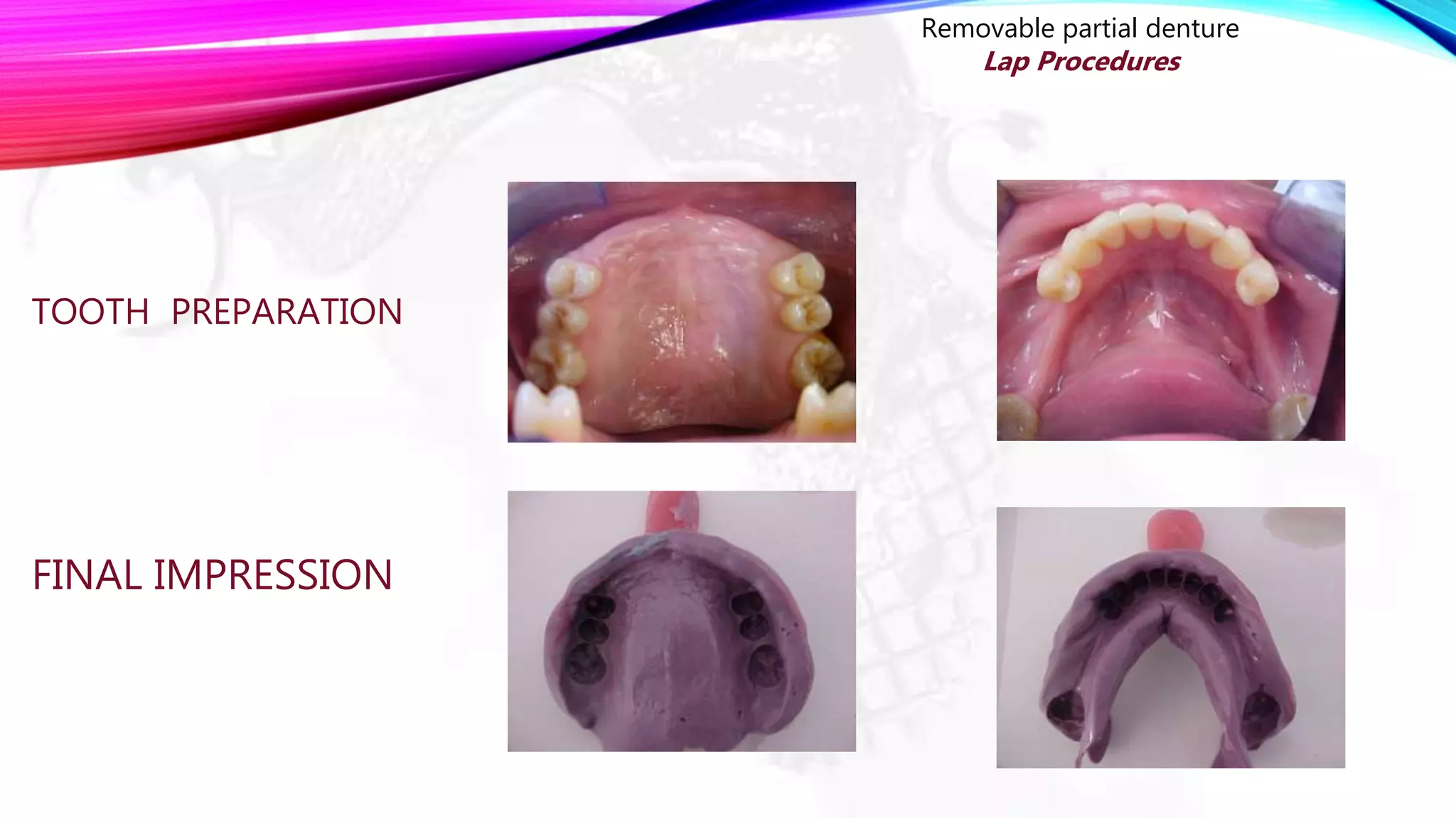 Lab steps of partial denture framework construction | PPTX