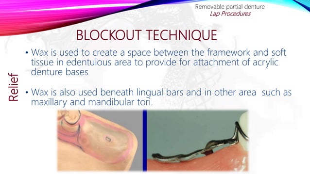 Lab steps of partial denture framework construction | PPTX