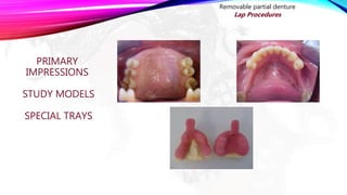Lab steps of partial denture framework construction | PPTX